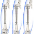 Leg Lengthening Surgery with PRECICE