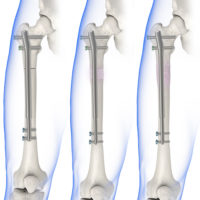Leg Lengthening Surgery with PRECICE