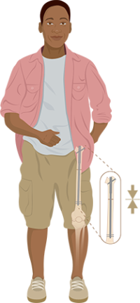 One Leg Is Longer Than The Other Leg Length Discrepancy Treatment