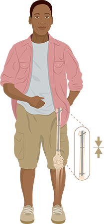 One Leg Is Longer Than The Other Leg Length Discrepancy Treatment