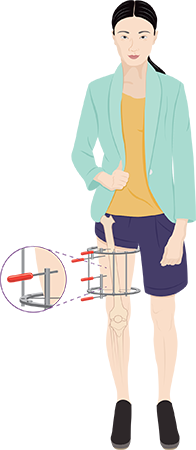 External Fixation - Leg Length Discrepancy (LLD) Treatment