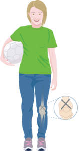 Epiphysiodesis (Growth Arrest) - Leg Length Discrepancy Treatment