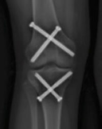 Epiphysiodesis (Growth Arrest) - Leg Length Discrepancy Treatment