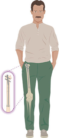 Leg Lengthening Surgery with PRECICE