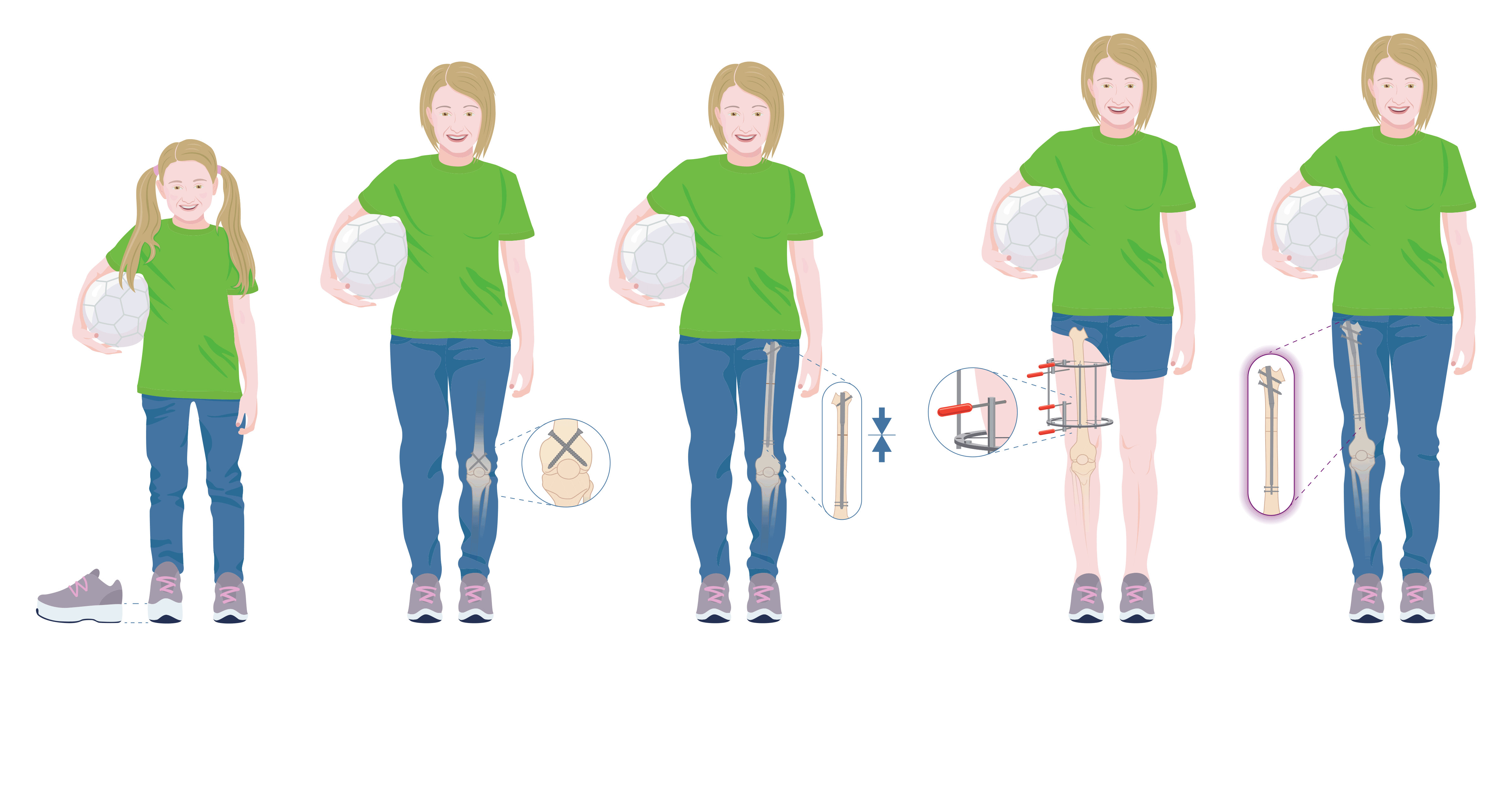 Can You Get Leg Shortening Surgery
