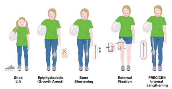 PreCice - Reach Your Height: PRECICE Limb Lengthening System