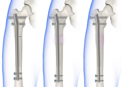 Find a Limb Lengthening Surgeon - Reach Your Height: PRECICE Limb ...